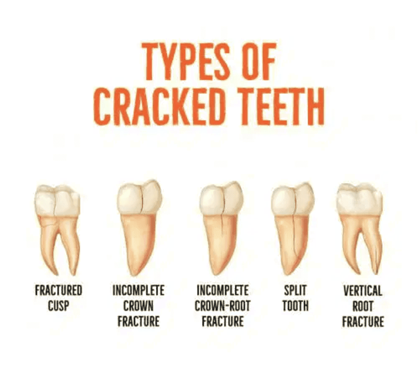 Types of Tooth Cracks: A Dentist's Guide